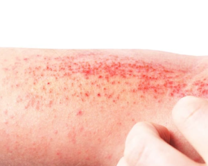 Atopi Nedir? Atopik Hastalıklar Nelerdir? • Kadın Bakışı